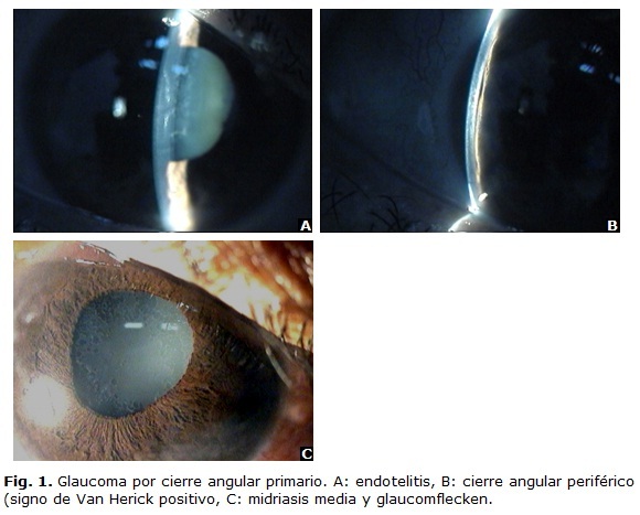 Consideraciones terapéuticas en el cierre angular primario | Fernández ...