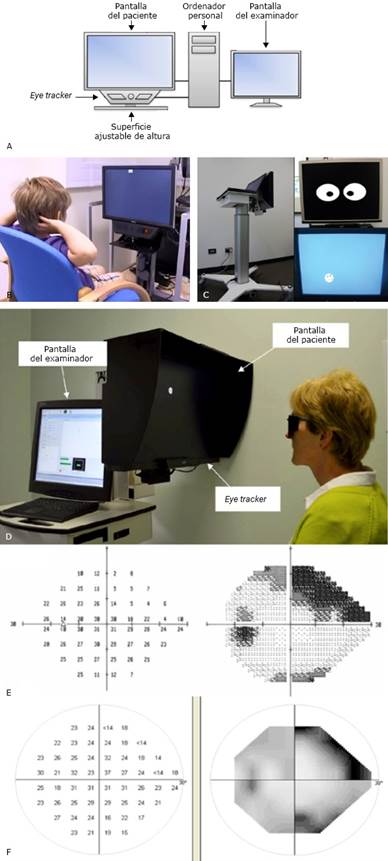 Perimetría computadorizada no estandarizada | Queupumil Rodríguez ...