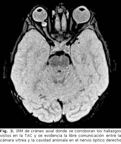 Correlación clínico-radiológica de las anomalías congénitas excavadas ...