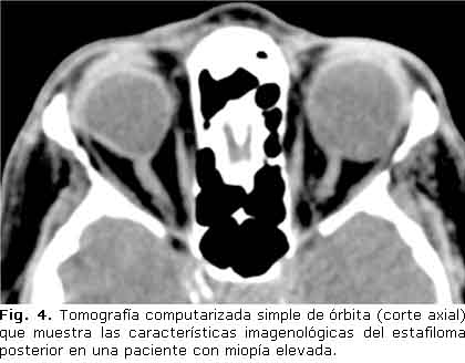 Correlación clínico-radiológica de las anomalías congénitas excavadas ...