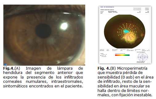 Manifestaciones oftalmológicas por virus de Epstein-Barr | Suñet ...