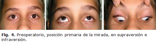 Presentación de dos casos con desviación vertical disociada relacionada ...