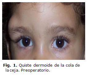Quiste dermoide en la cola de la ceja | Ramírez García | Revista Cubana ...