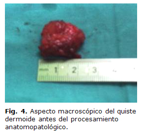 Quiste dermoide en la cola de la ceja | Ramírez García | Revista Cubana ...
