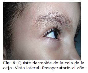 Quiste dermoide en la cola de la ceja | Ramírez García | Revista Cubana ...