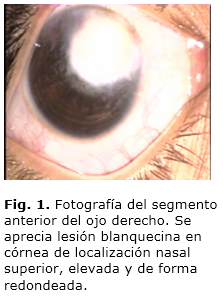 Quiste dermoide corneal bilateral | Casas Arias | Revista Cubana de ...