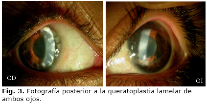 Quiste dermoide corneal bilateral | Casas Arias | Revista Cubana de ...