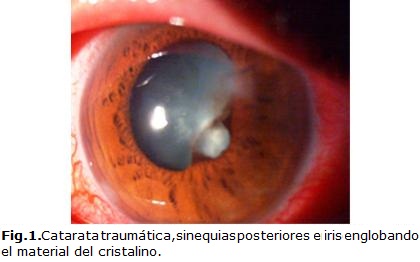 Trauma ocular a globo abierto en zona I | Cruz Izquierdo | Revista ...