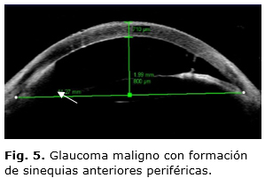 El glaucoma maligno | Hernández Pardines | Revista Cubana de Oftalmología