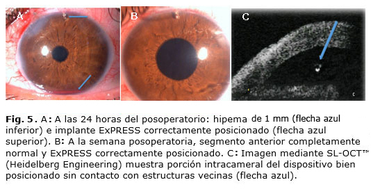 Implante ExPRESS-P en el glaucoma traumático | Fumero González ...