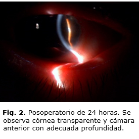 Glaucoma refractario y catarata: un reto quirúrgico | Díaz Águila ...