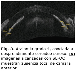 Glaucoma refractario y catarata: un reto quirúrgico | Díaz Águila ...
