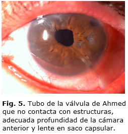 Glaucoma refractario y catarata: un reto quirúrgico | Díaz Águila ...