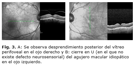 Edema macular quístico posterior a la cirugía de agujero macular ...