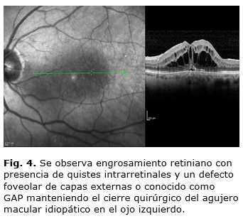 Edema macular quístico posterior a la cirugía de agujero macular ...