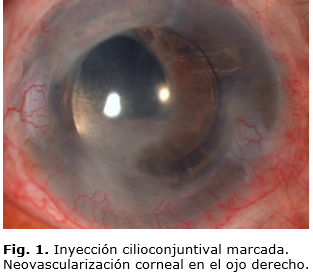 Glaucoma neovascular y atrofia esencial de iris | sanchez | Revista ...