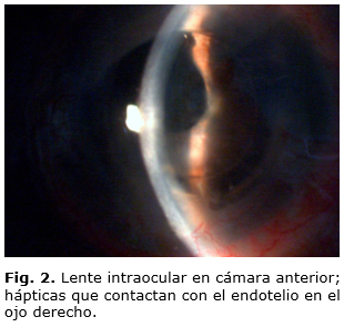 Glaucoma neovascular y atrofia esencial de iris | sanchez | Revista ...
