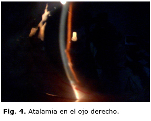 Glaucoma neovascular y atrofia esencial de iris | sanchez | Revista ...
