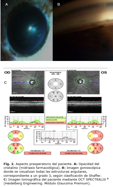 Trabeculotomía gonioasistida modificada, una alternativa quirúrgica ...