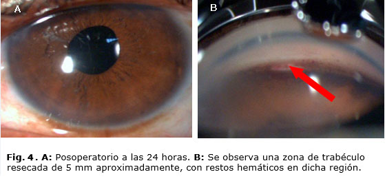Trabeculotomía gonioasistida modificada, una alternativa quirúrgica ...