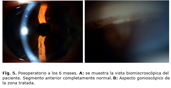 Trabeculotomía gonioasistida modificada, una alternativa quirúrgica ...