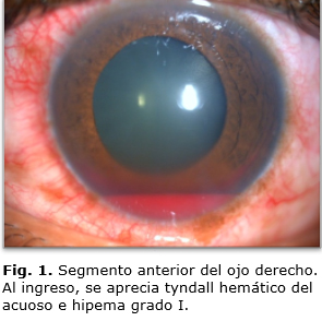 Hipema traumático en paciente con hemoglobinopatía | Cambas Andreu ...