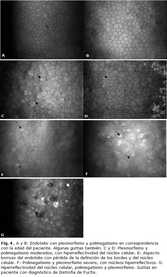 Microscopia confocal de la córnea en facoemulsificación | Hernández ...