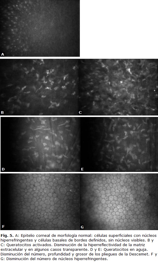 Microscopia confocal de la córnea en facoemulsificación | Hernández ...