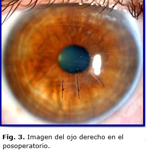 Opción terapéutica para la apertura de incisiones corneales ...